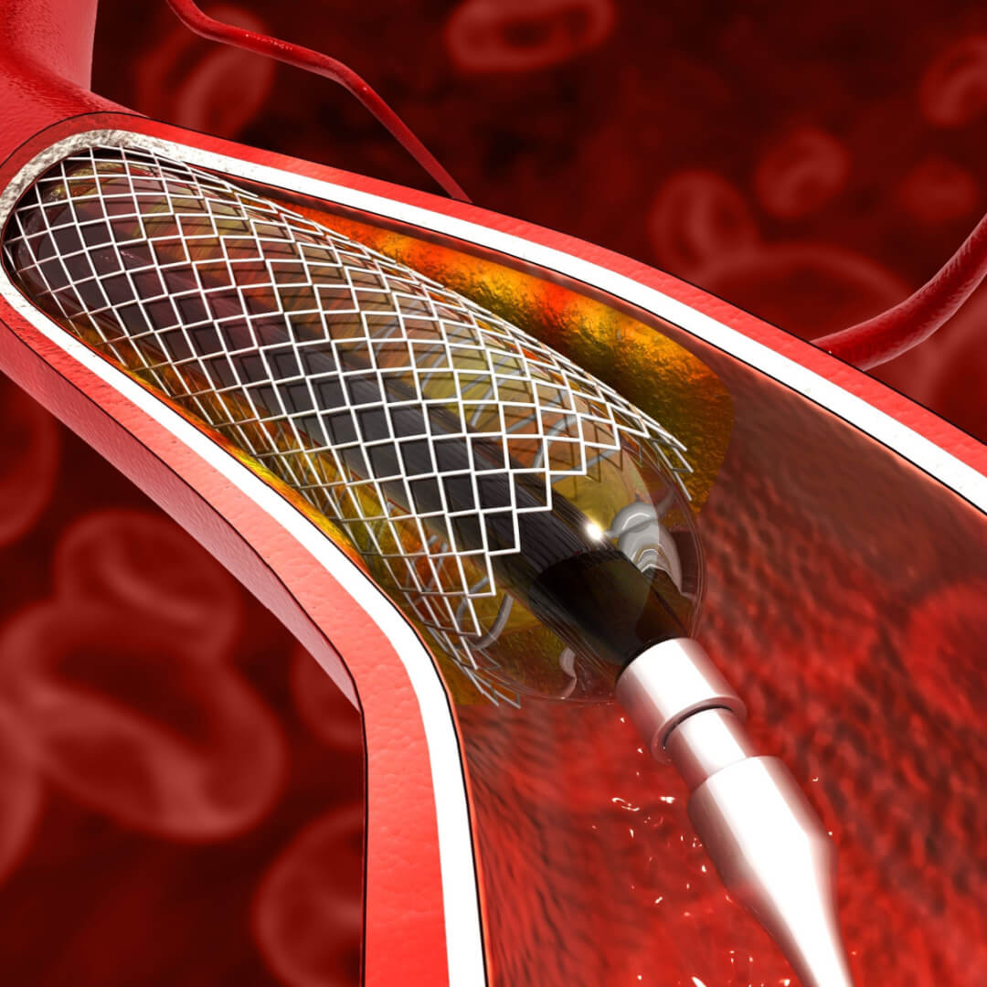Cardiac Catheterization - Shifaay