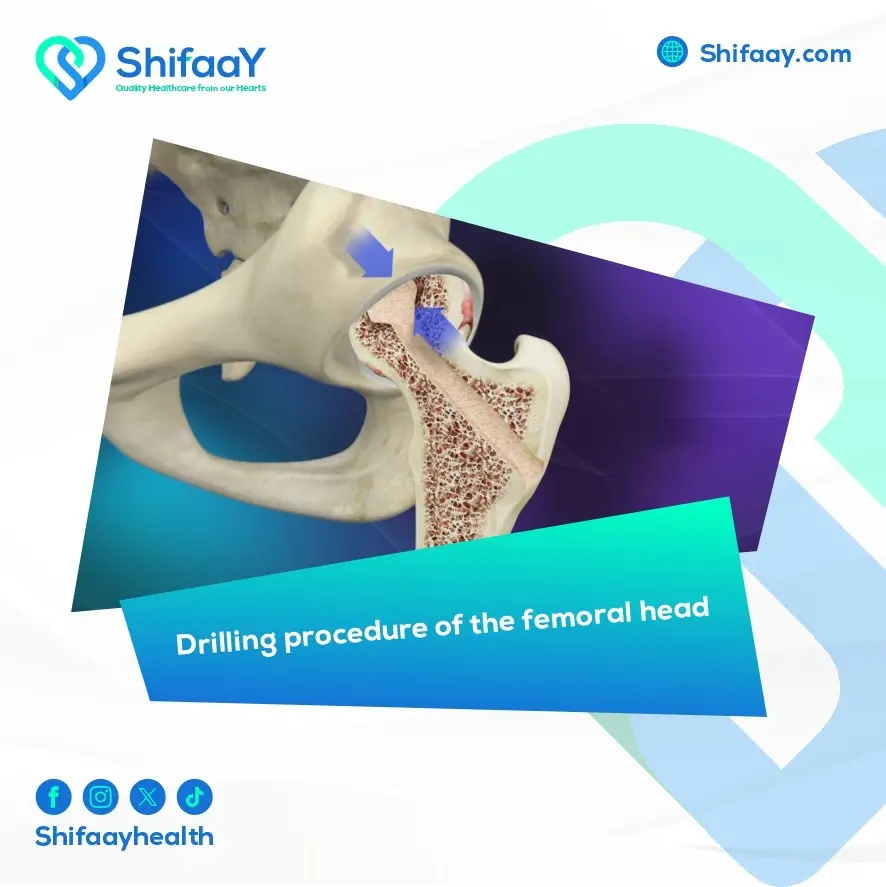 Femoral Head Drilling Procedure - Shifaay