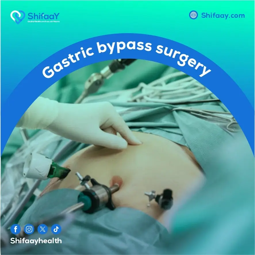 Gastric Bypass Surgery - Shifaay