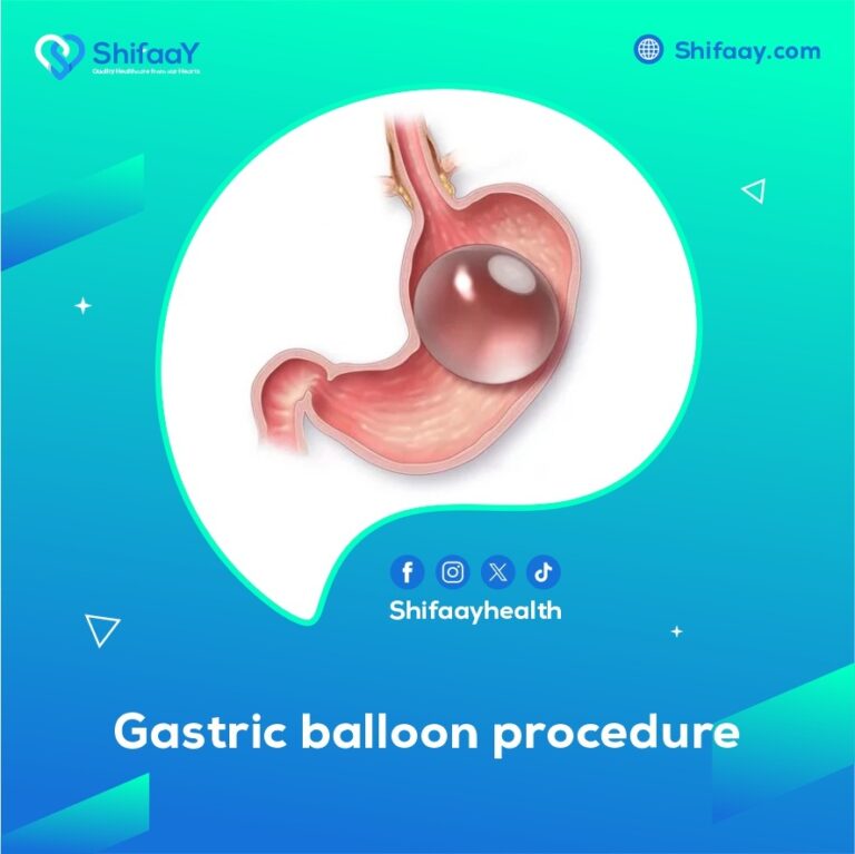 What is the Gastric Balloon Procedure? - Shifaay