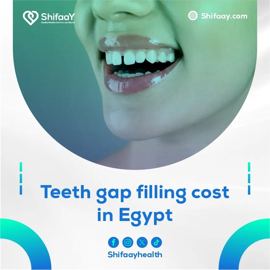 Teeth Gap Filling Cost in Egypt - Shifaay